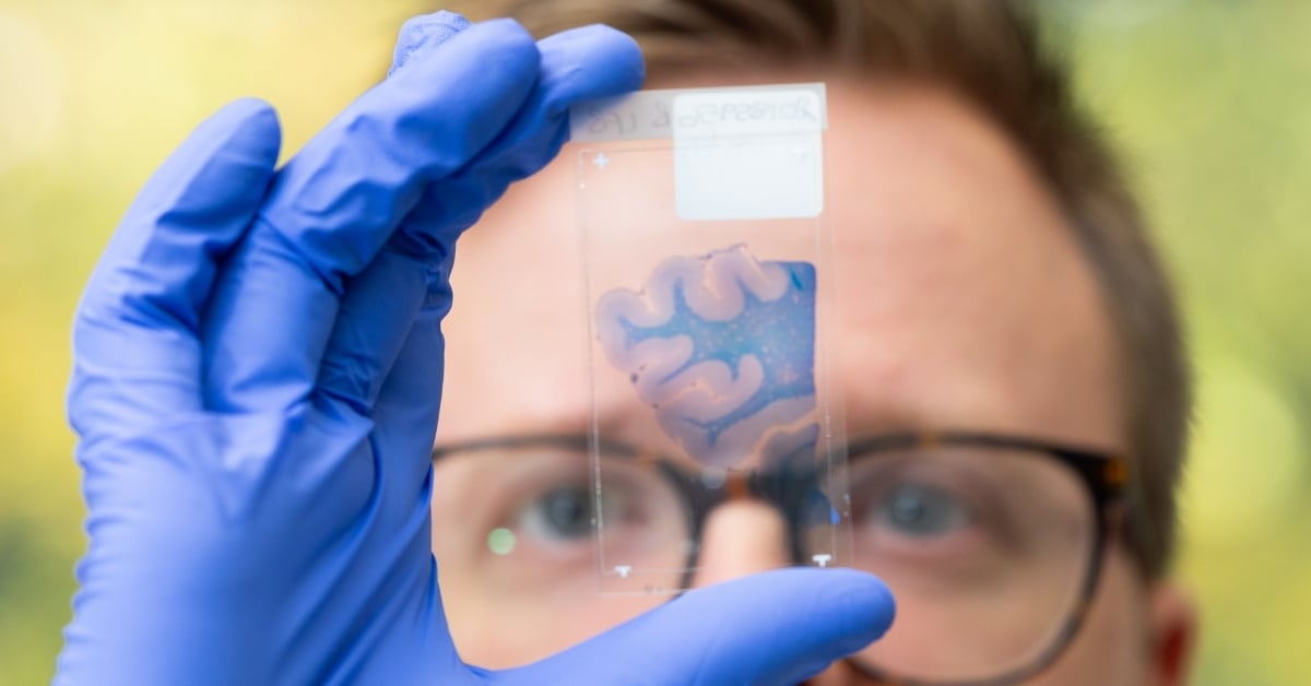 Living with Dementia with Lewy bodies: Nigel's story and Newcastle research